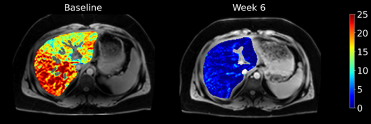 Pemvidutide | Altimmune